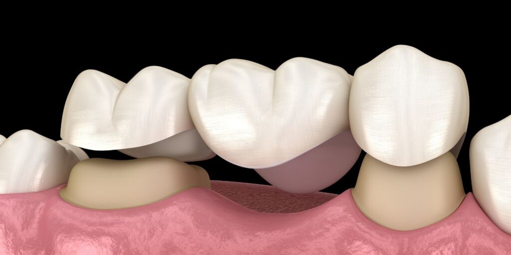 Everything You Need To Know About Dental Bridges - TwentyOneDental